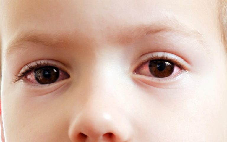 How Long Is Pink Eye Contagious? Here Are Signs To Know